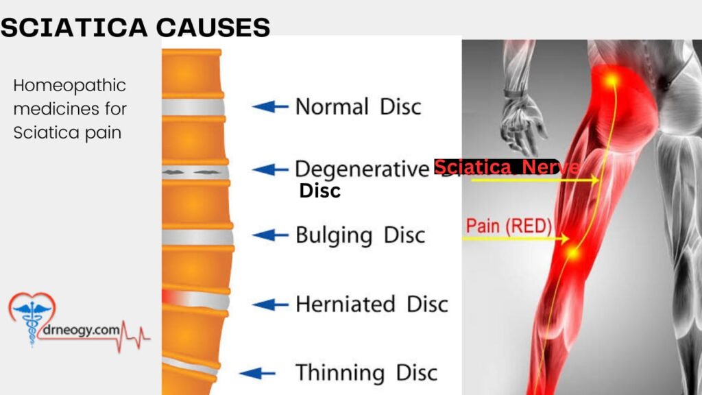 Top 5 sciatica homeopathic medicine
