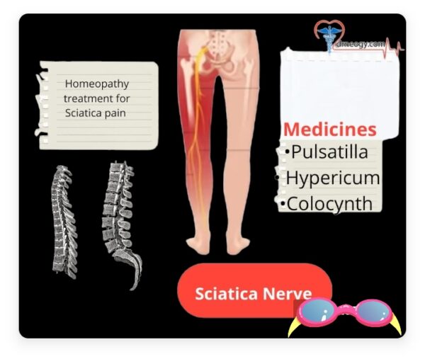 Top 5 sciatica homeopathic medicine
